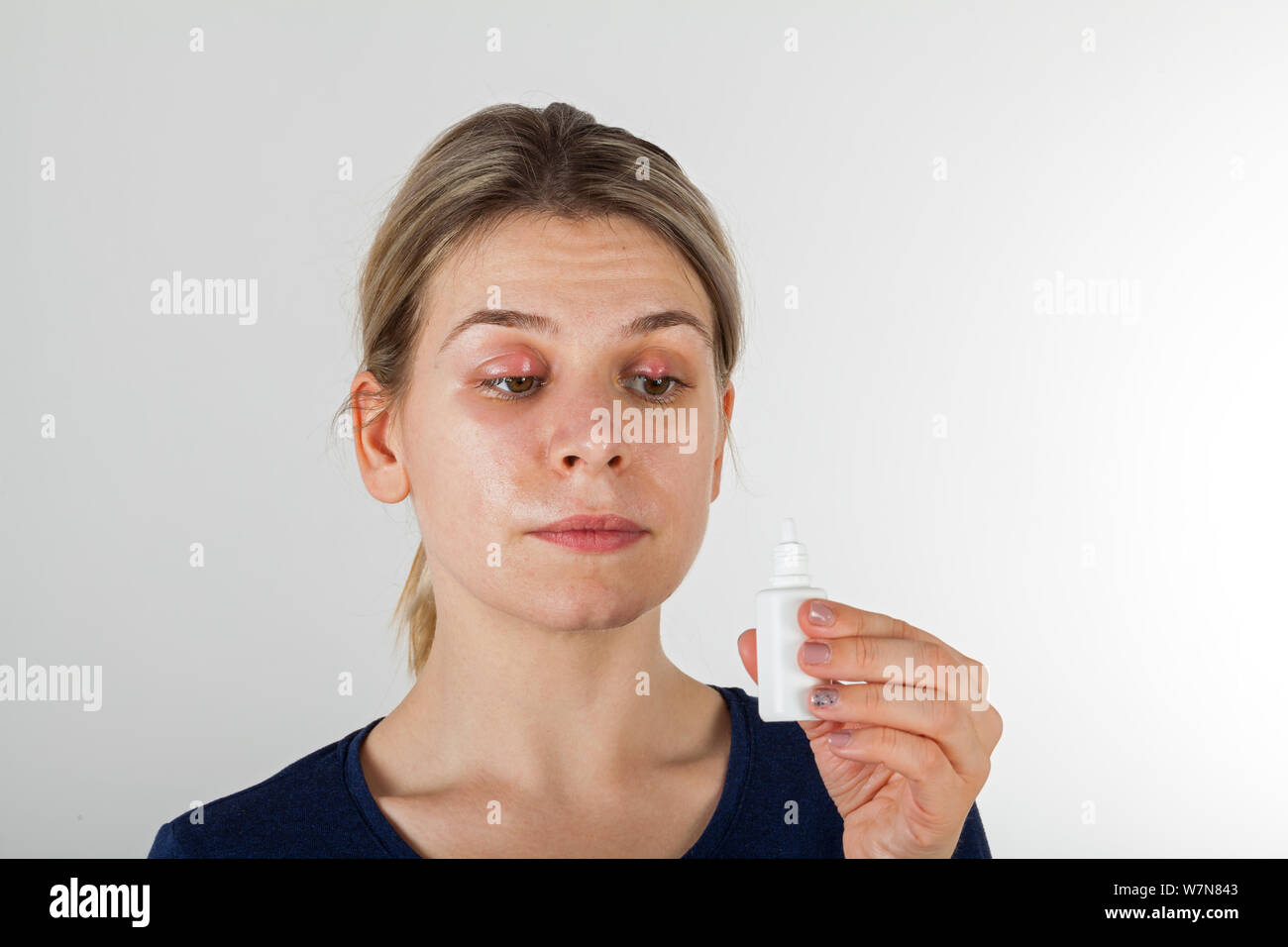 Swollen abscess hi-res stock photography and images - Alamy