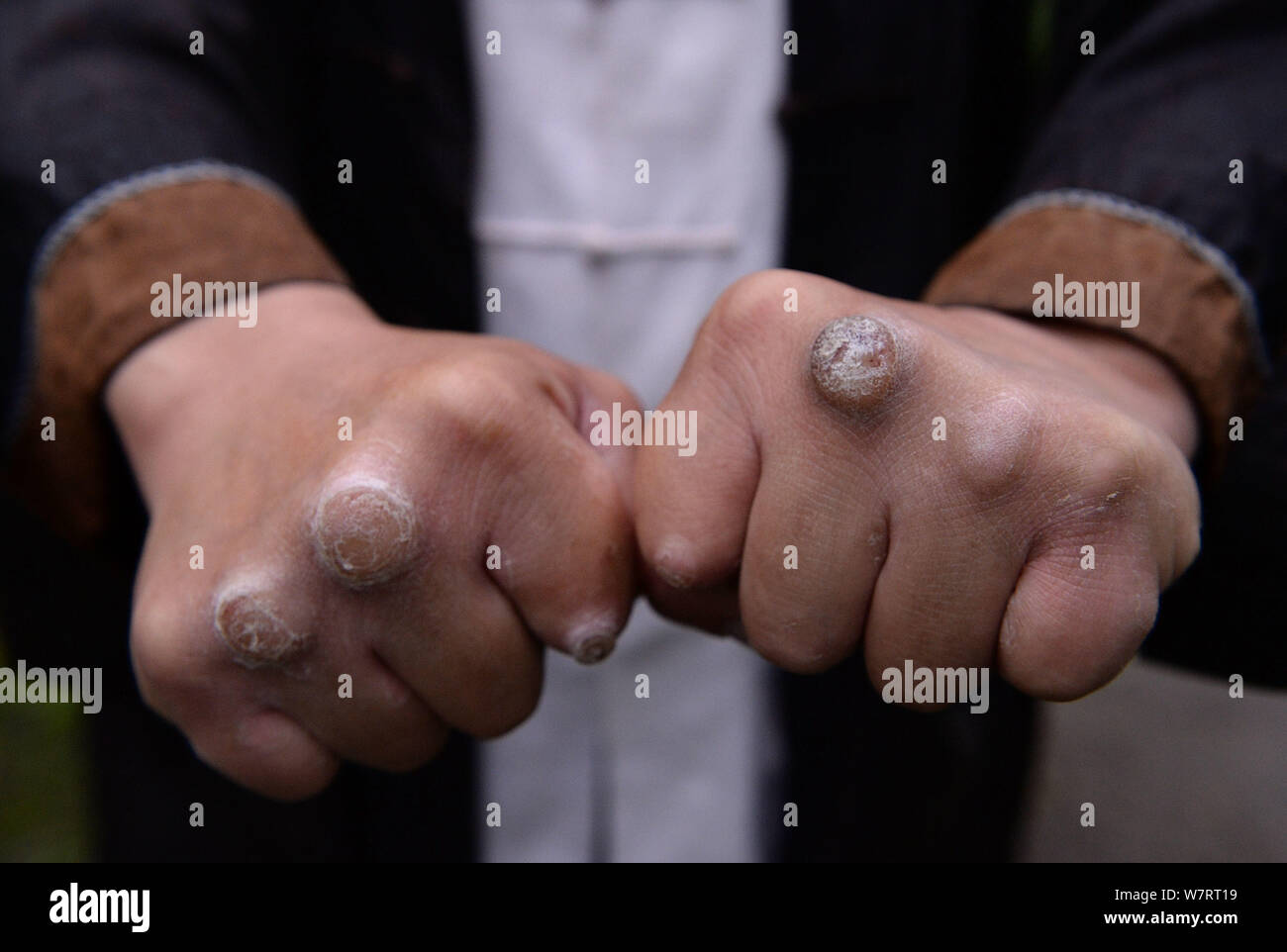 View of callus on the hands of He Daojun, the master of Chengdu ...