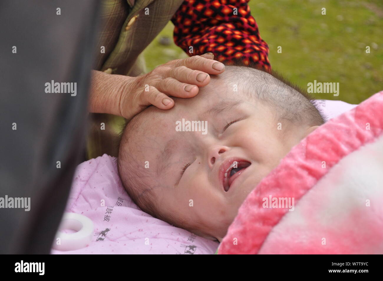 Severe Hydrocephalus In Fetus