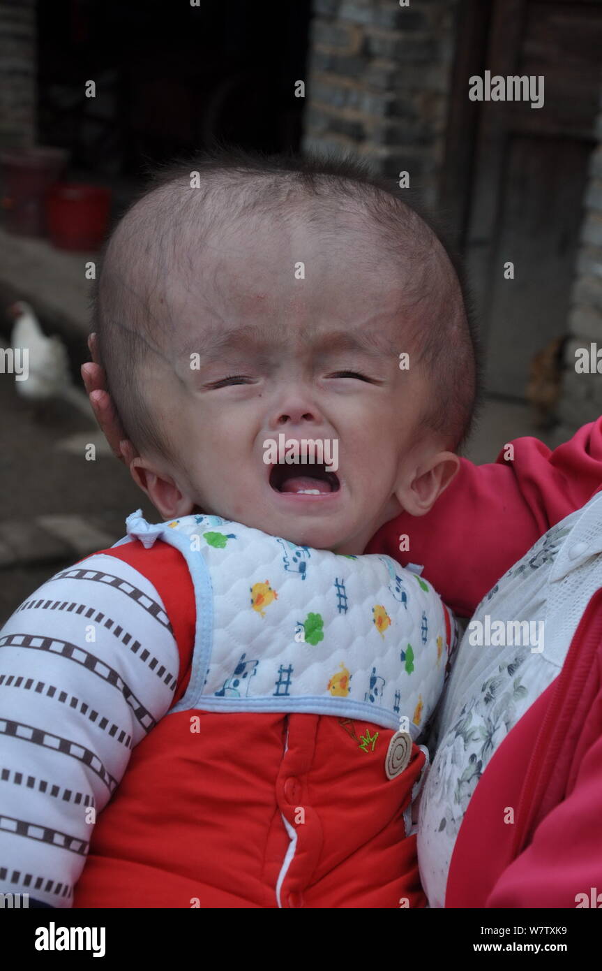 Hydrocephalus old hi-res stock photography and images - Alamy