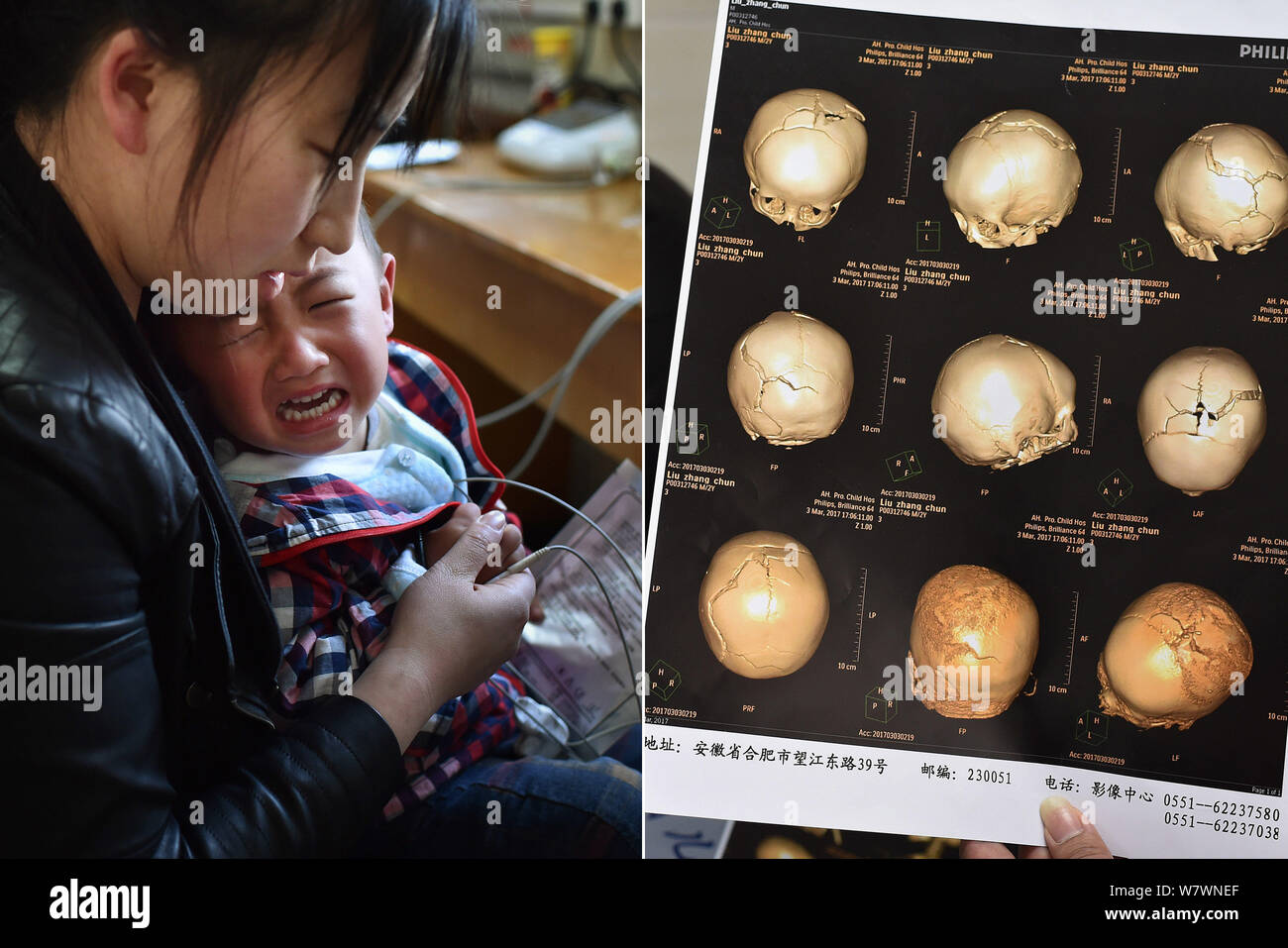 A brain CT scan shows the cracks on two-year-old boy Chinese boy Zhang ...