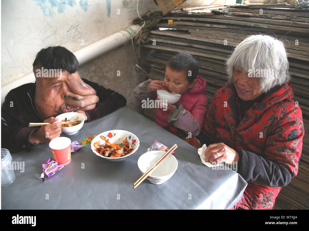 'China's Elephant Man' Huang Chuncai, 41, who suffers from a 15kg huge ...