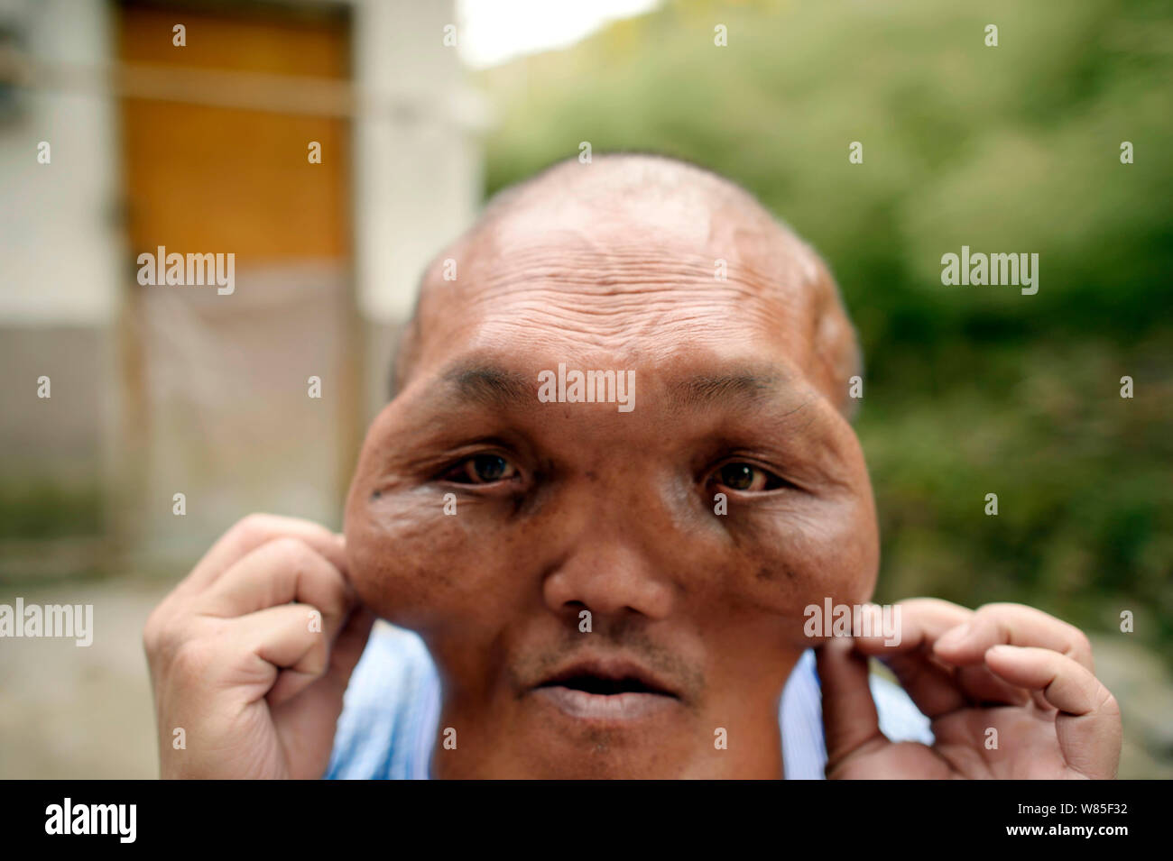 Chinese villager Xia Yuanhai who has an alien-like deformed face poses ...