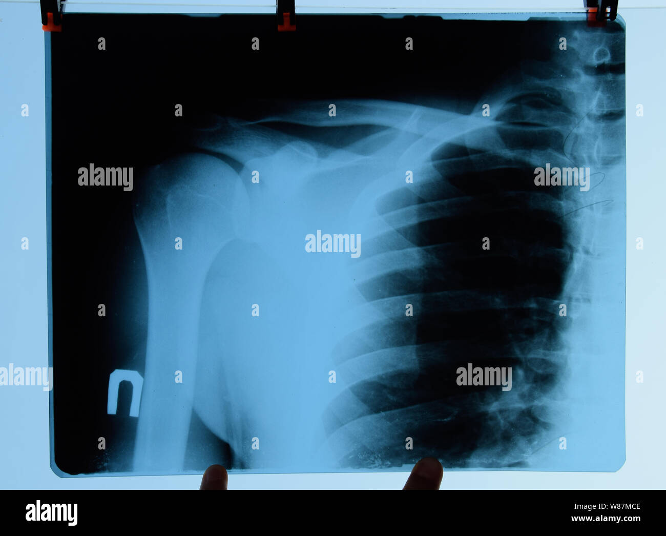 X-ray of shoulder and clavicle, X-ray picture of shoulder joint Stock ...