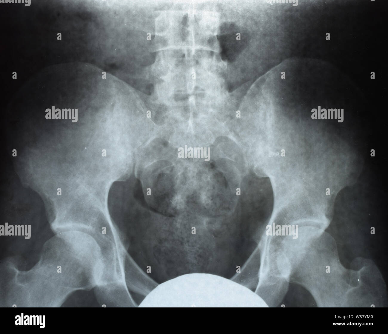 Sacrum Anatomy Xray