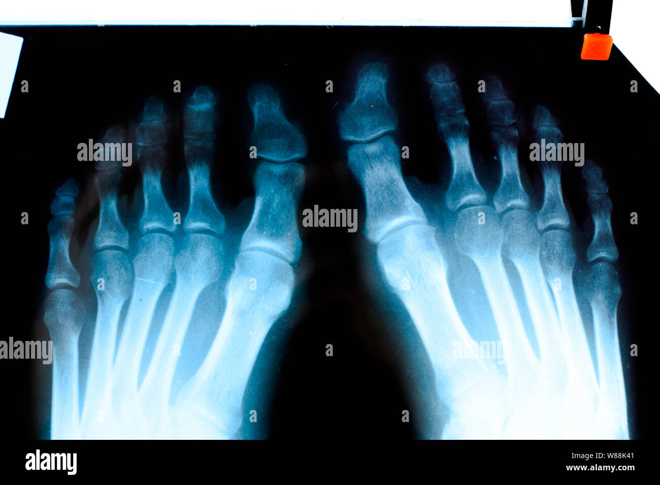 X-ray of toes. Foot on X-ray. bone research Stock Photo - Alamy