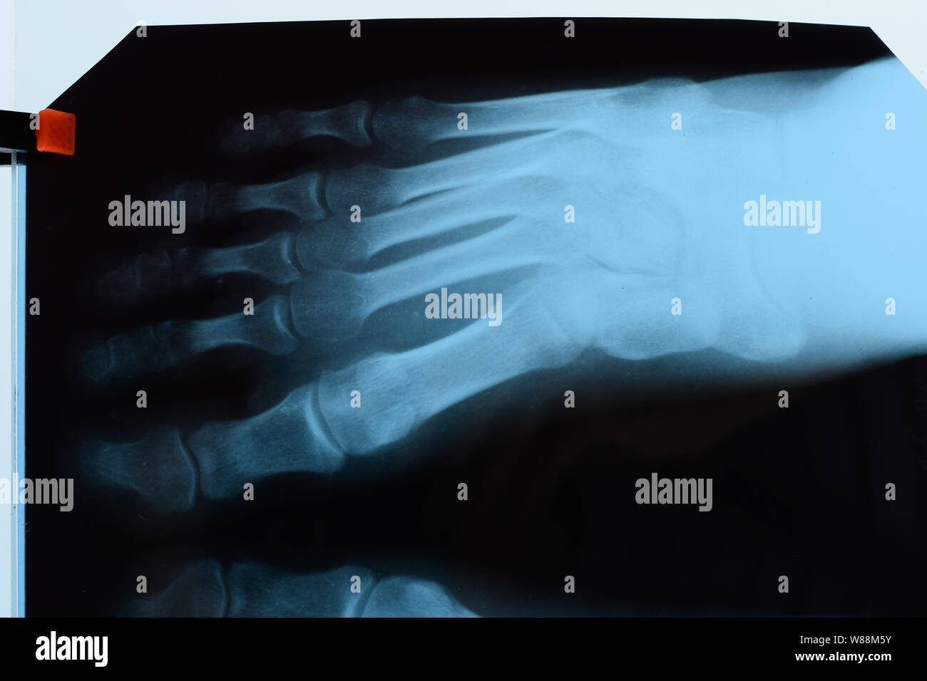 X-ray of toes. Foot on X-ray. bone research Stock Photo - Alamy