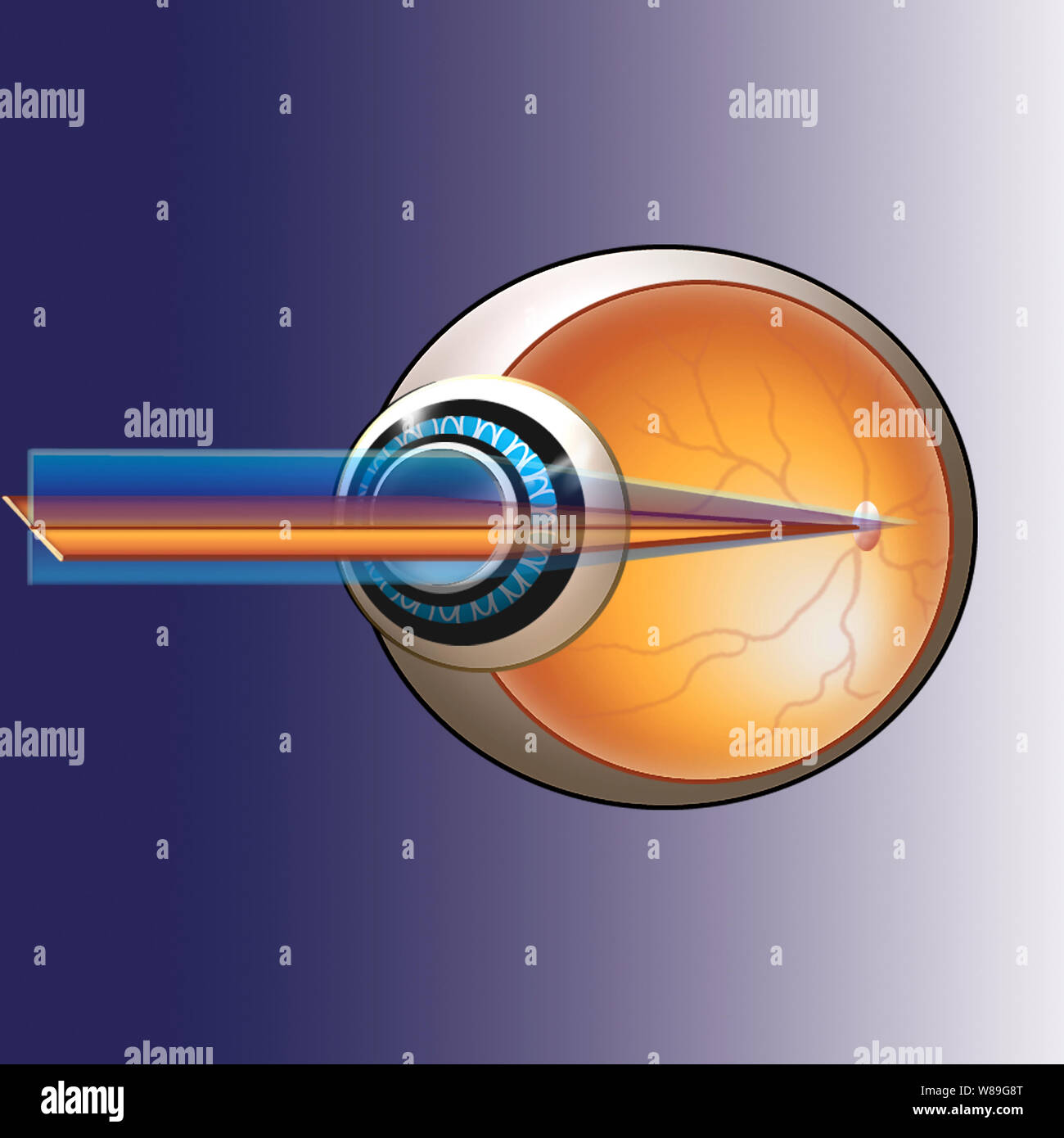 Astigmatic lens hi-res stock photography and images - Alamy