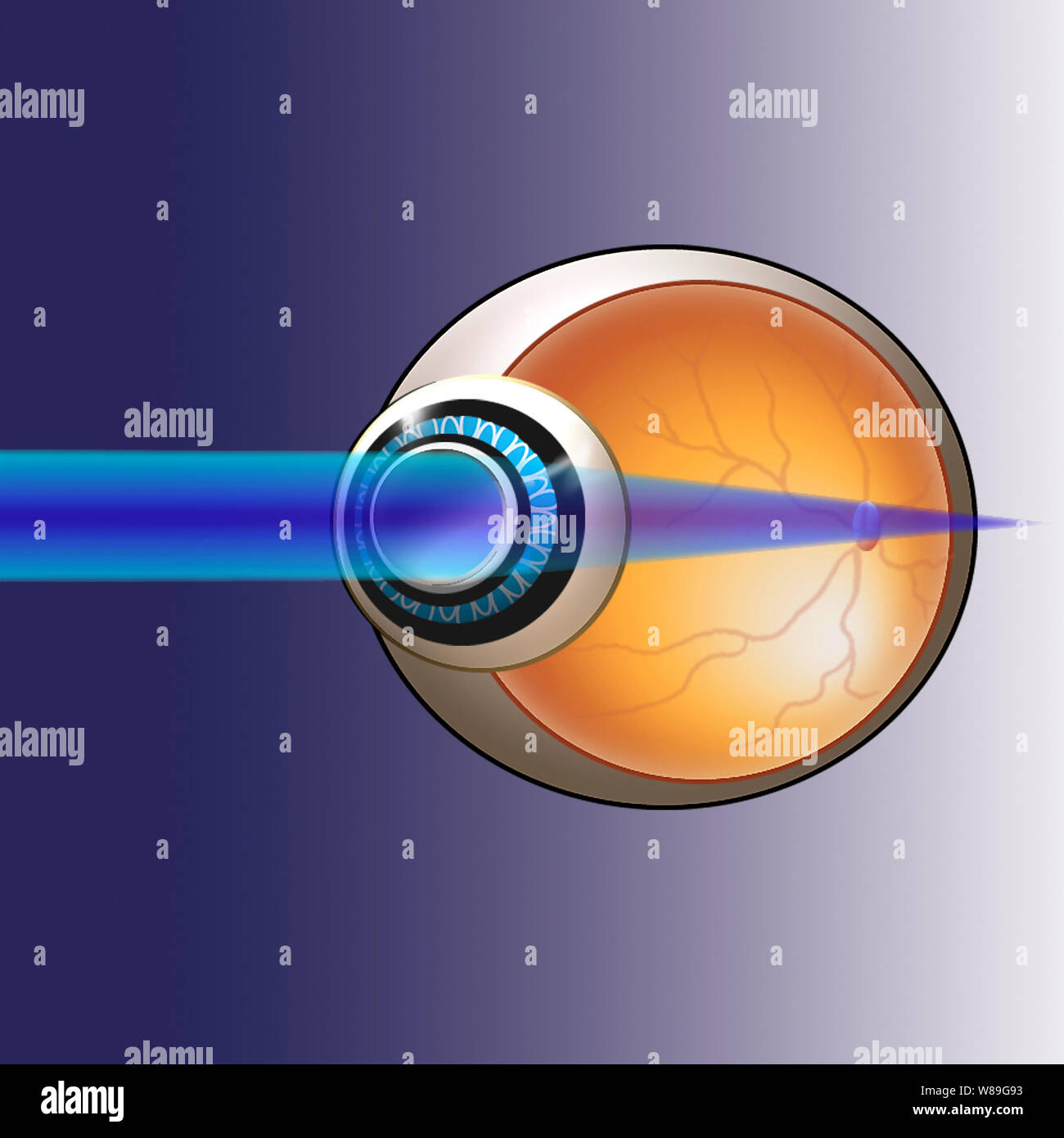 eyeball illlustration displaying nearsighted using beams entering the ...
