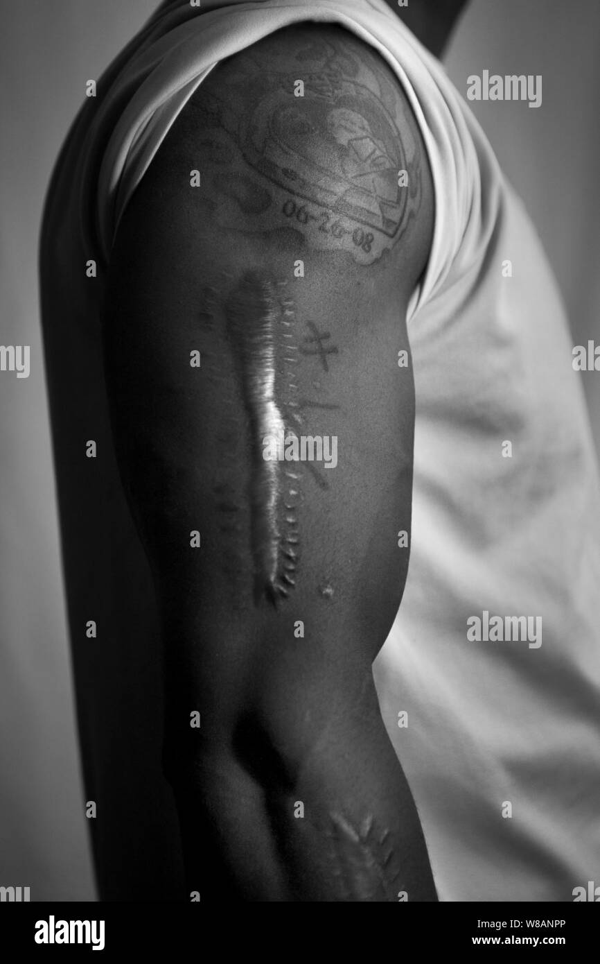 Deployment Scars - A suicide bomber in Iraq injured Marine veteran ...