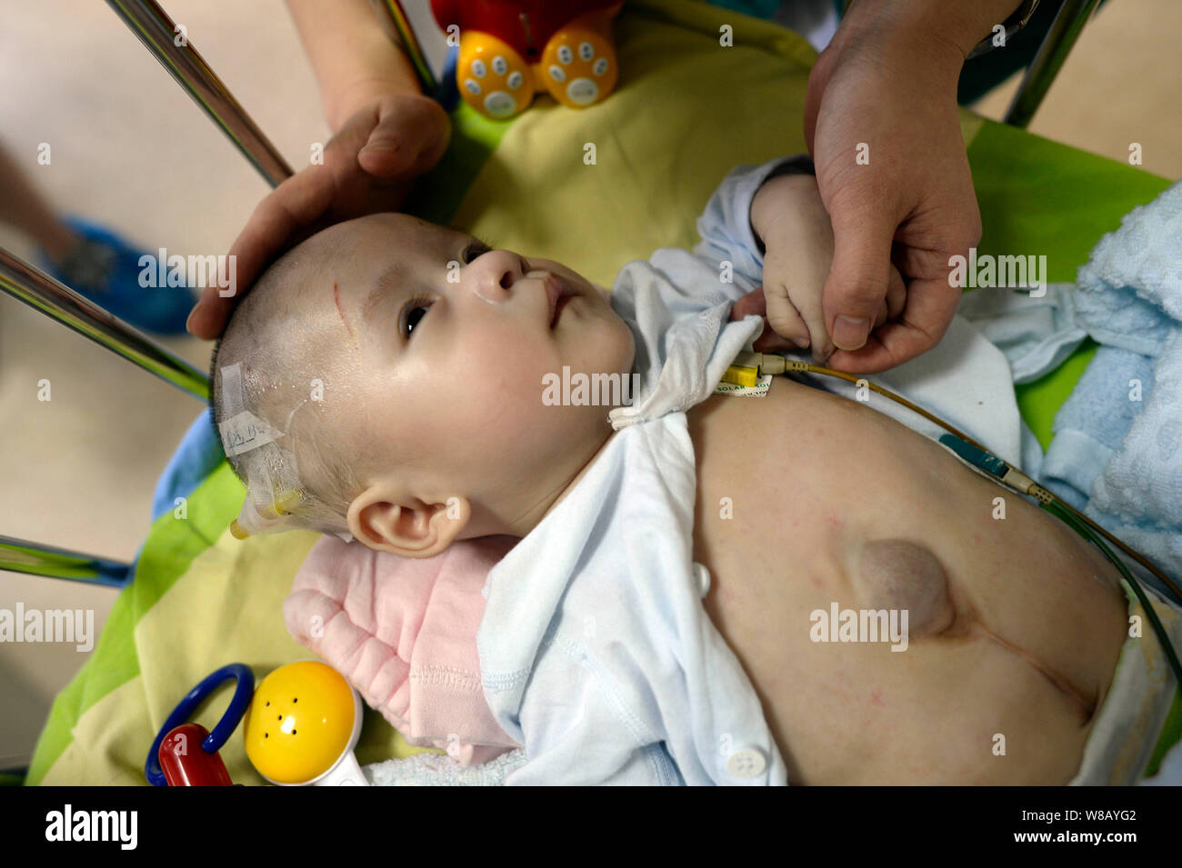 Newborn baby An An, who suffers from heart protrusion, is pictured ...