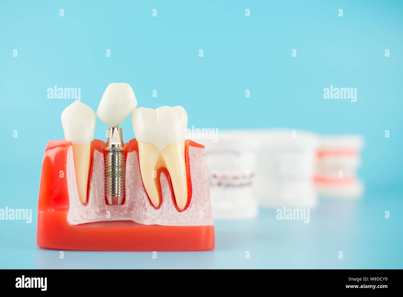 Dental implant model with other dental model on background Stock Photo ...