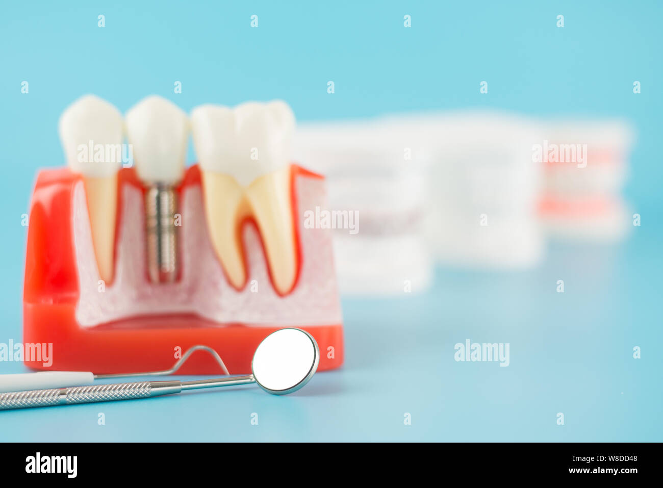 Dental implant model with other dental model on background Stock Photo ...