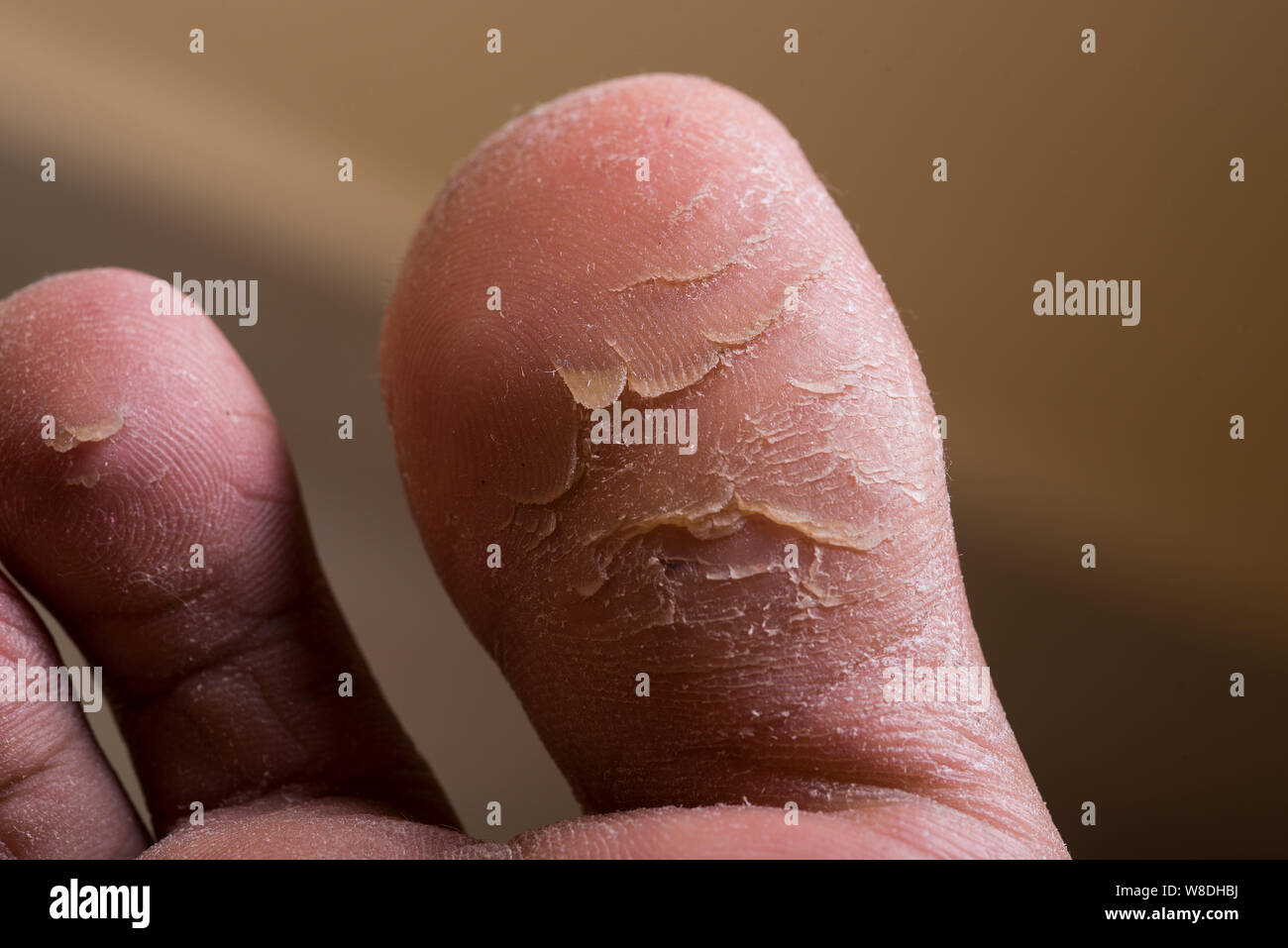 A skin disorder called Callus occurs on feet toe closeup Stock Photo ...