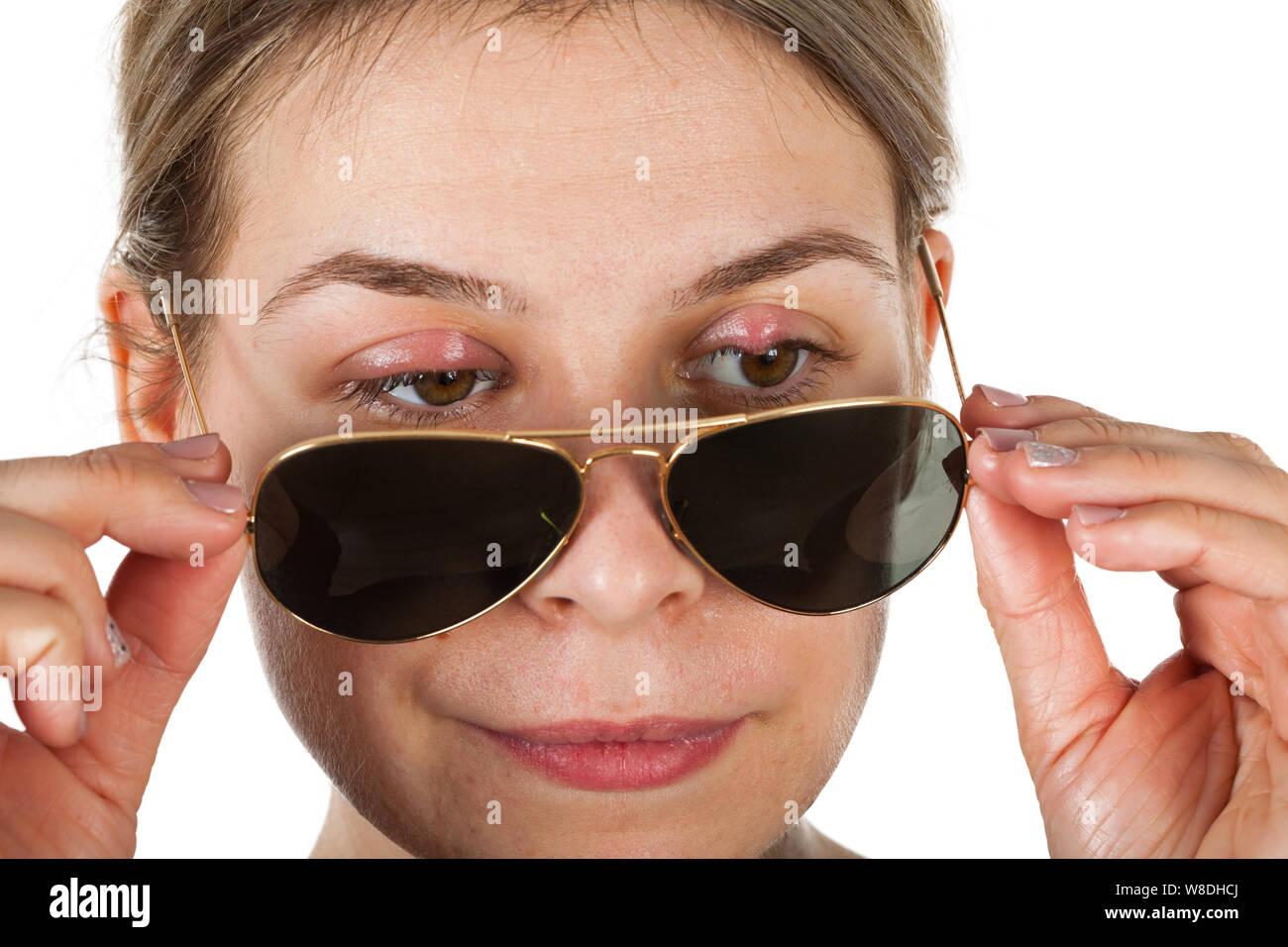 Portrait of a young woman with severe eye infection - isolated ...