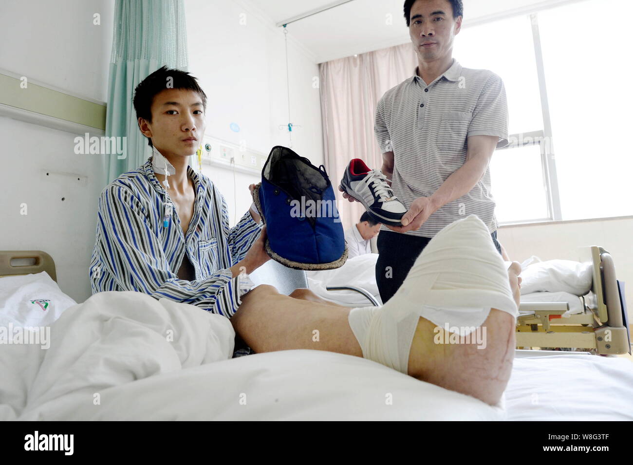 Liu Huichang, left, who suffers from local gigantism shows his gigantic ...