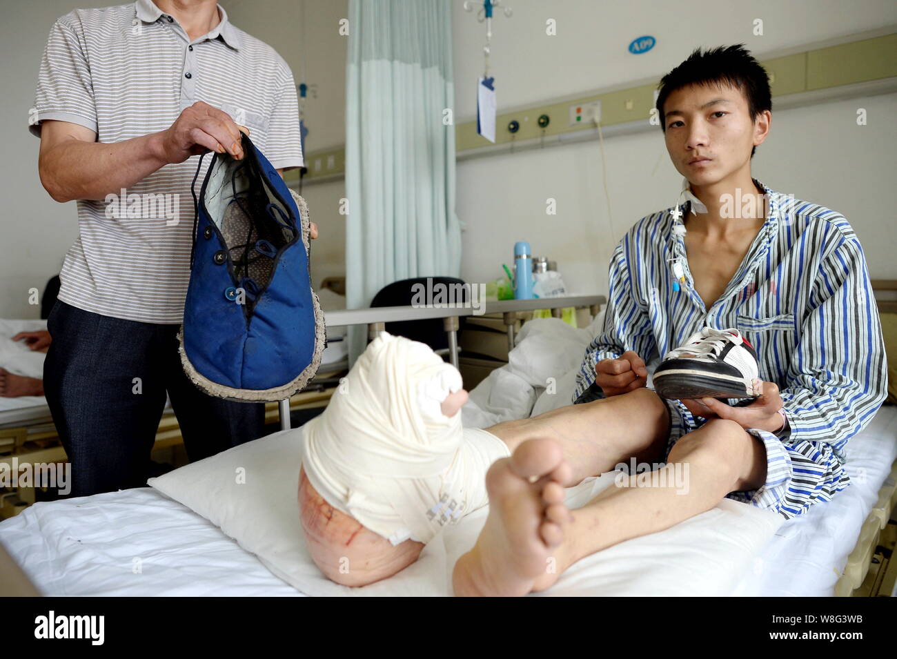 Liu Huichang, right, who suffers from local gigantism shows a normal ...