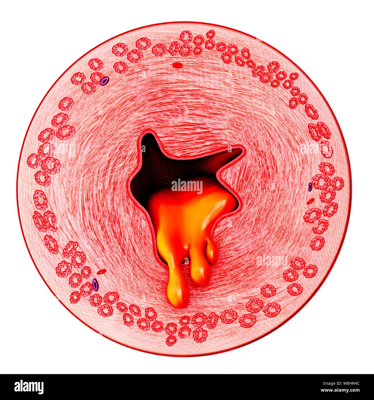 Illustration of bronchus with excess mucus Stock Photo - Alamy