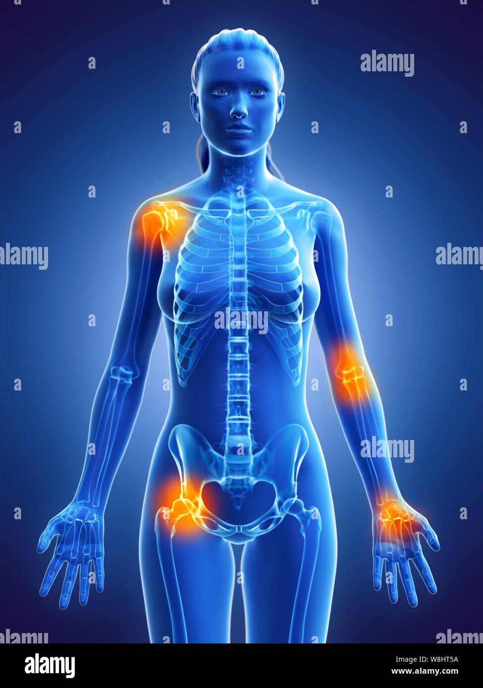 Joint pain, conceptual computer illustration Stock Photo - Alamy