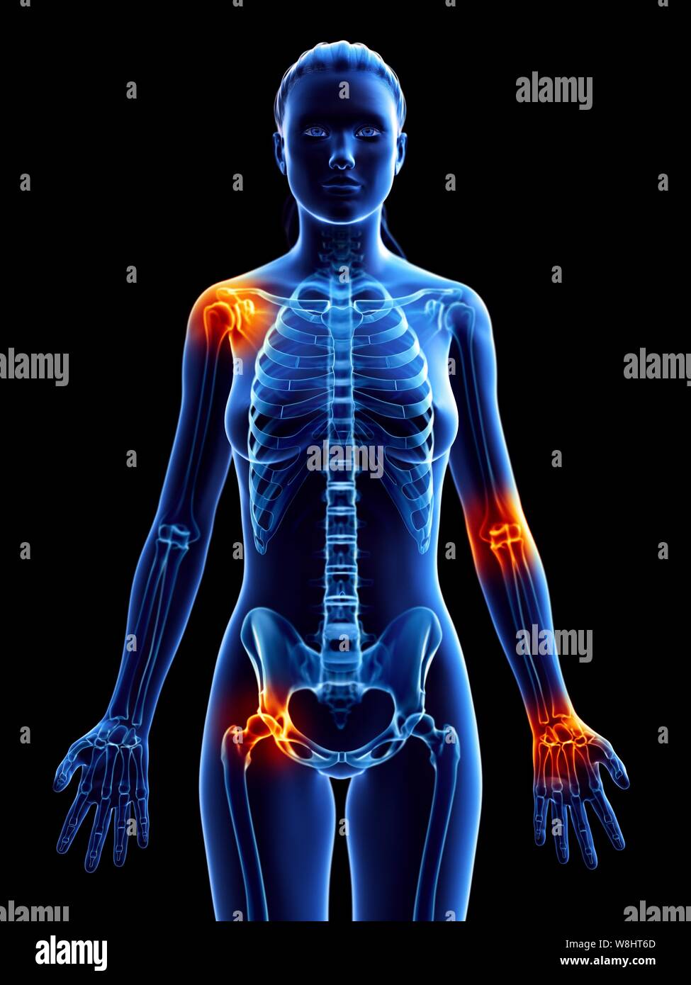 Joint pain, conceptual computer illustration Stock Photo - Alamy