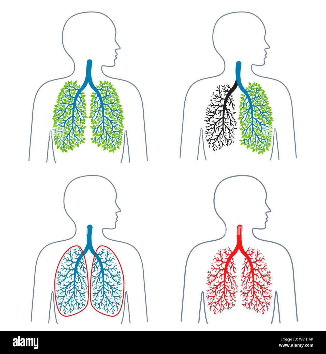 Set of illustrations of respiratory system theme.Tuberculosis. Lung ...