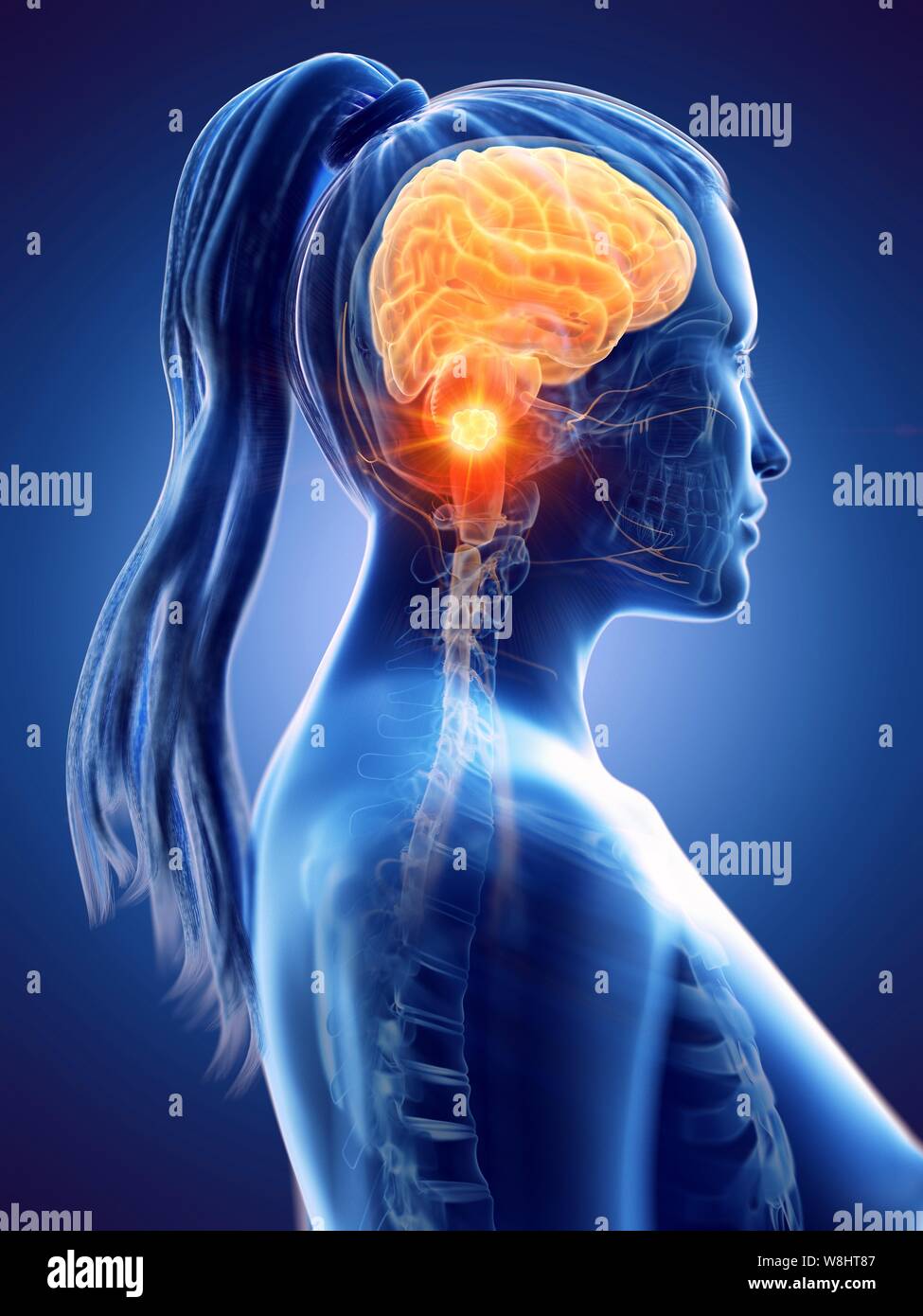 Brain cancer, conceptual computer illustration Stock Photo - Alamy