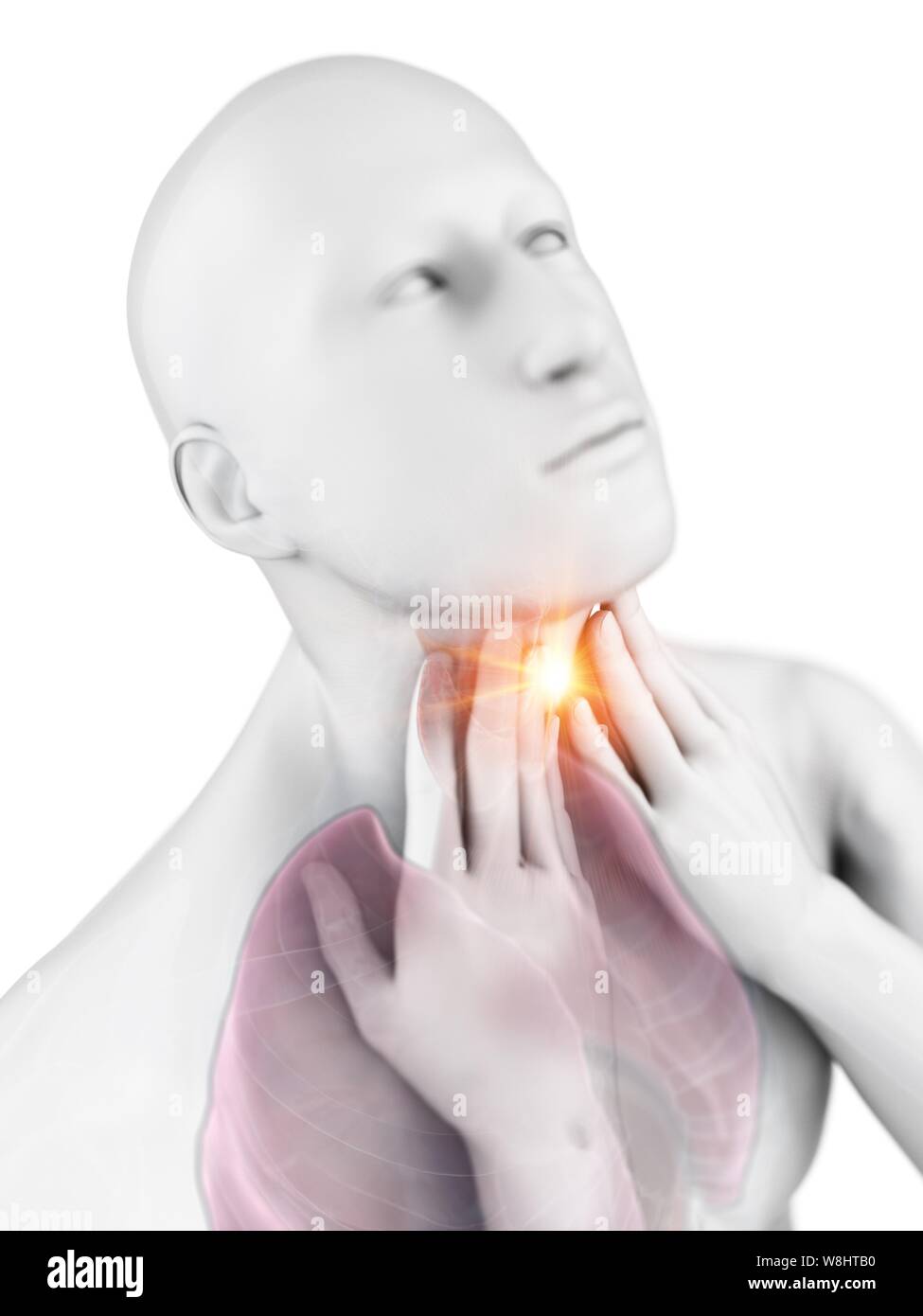 Sore throat, conceptual computer illustration Stock Photo - Alamy