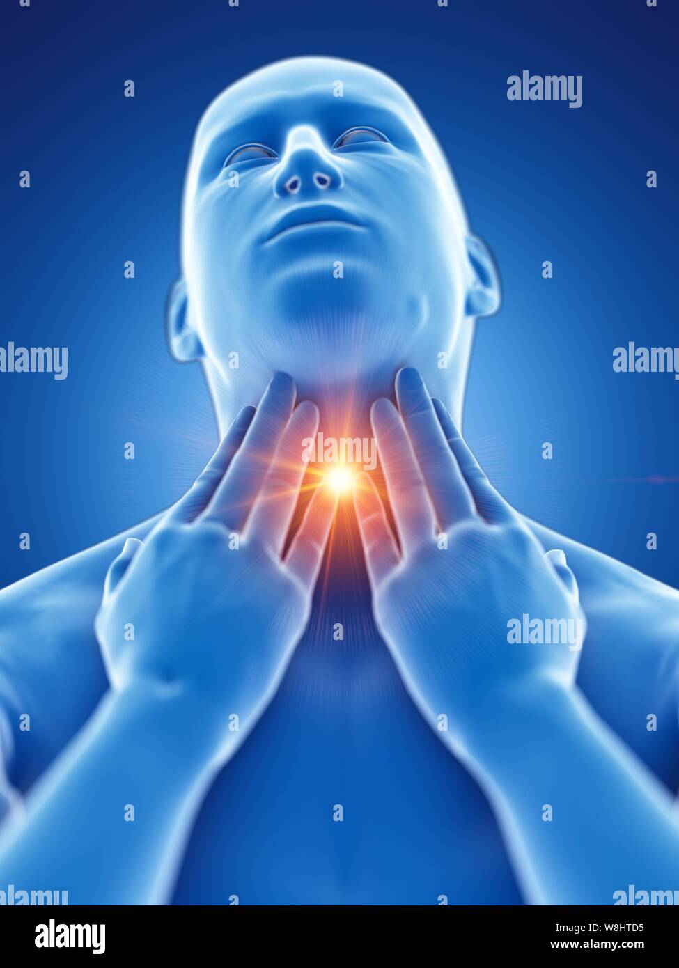 Sore throat, conceptual computer illustration Stock Photo - Alamy