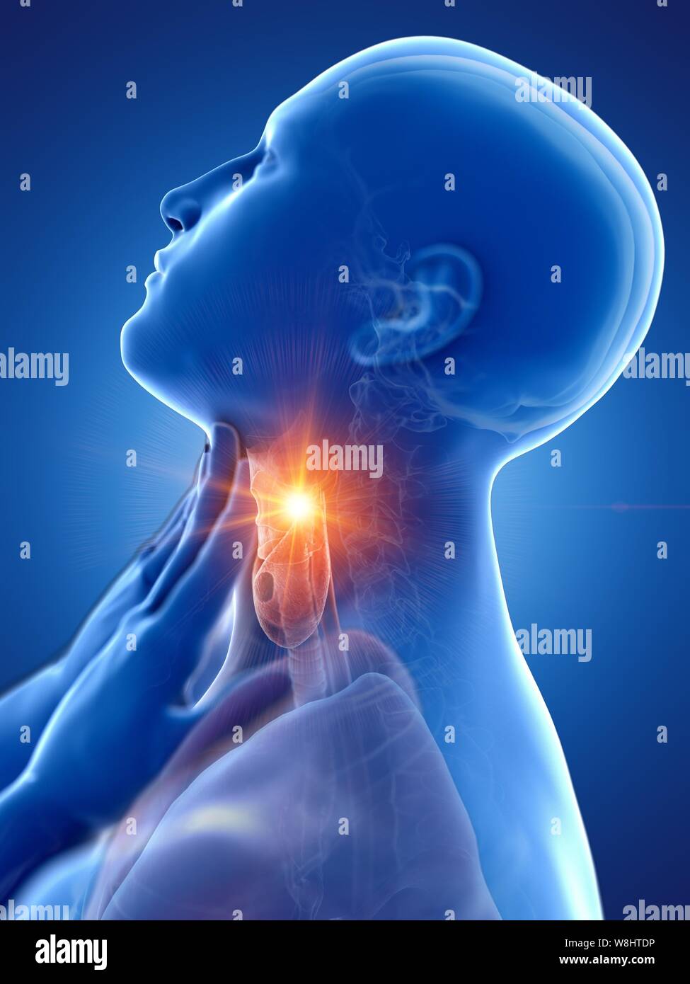 Sore throat, conceptual computer illustration Stock Photo - Alamy