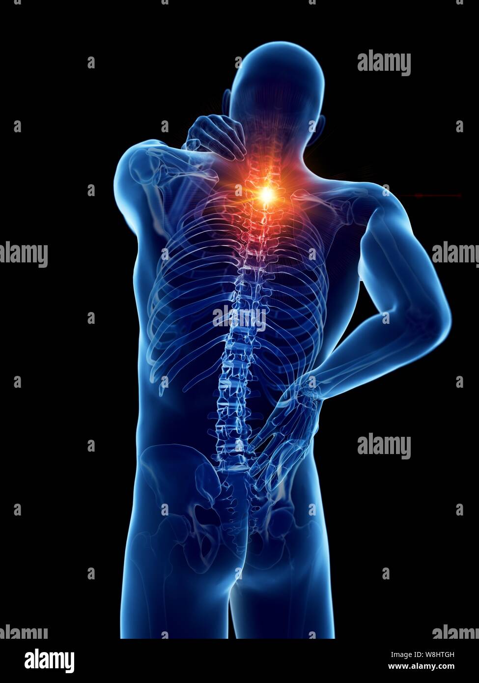 Back pain, computer illustration Stock Photo - Alamy