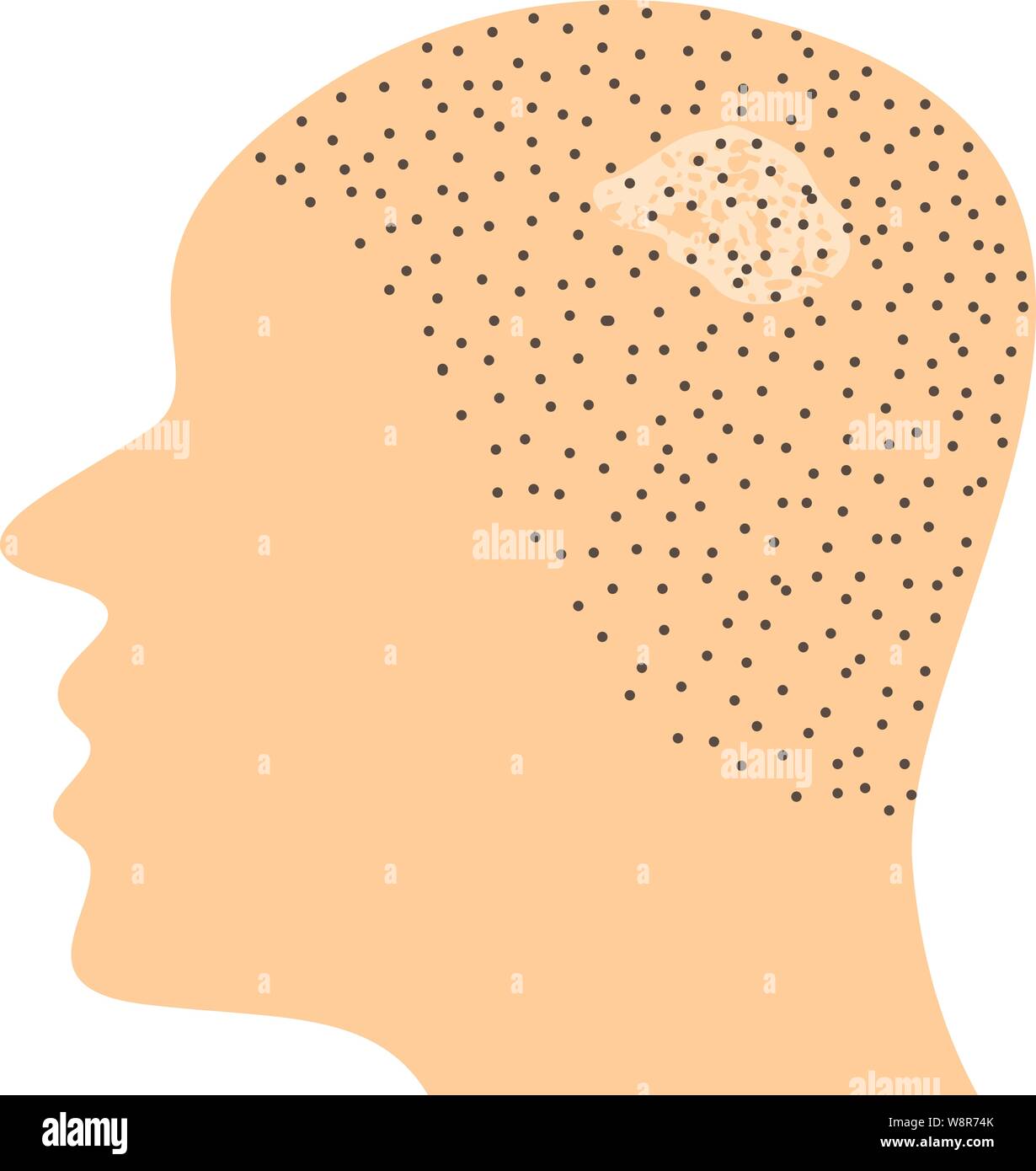 Fungal infection on scalp head vector illustration Stock Vector Image ...