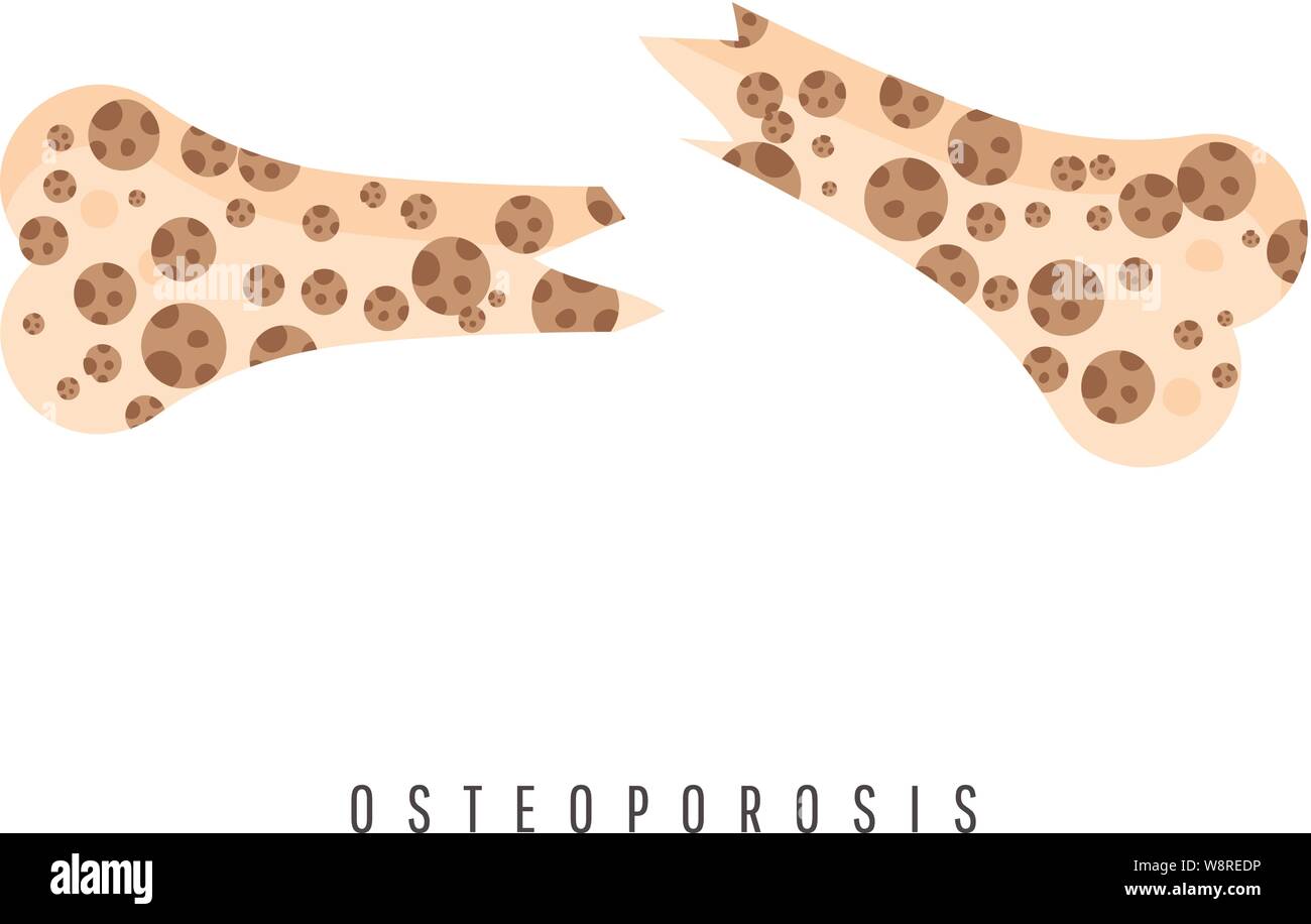 Compact bone tissue hi-res stock photography and images - Alamy