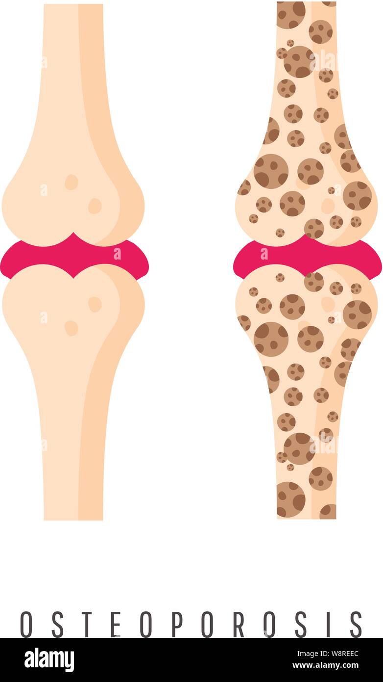 Two bones are normal and sore. Medical problem of osteoporosis disease ...