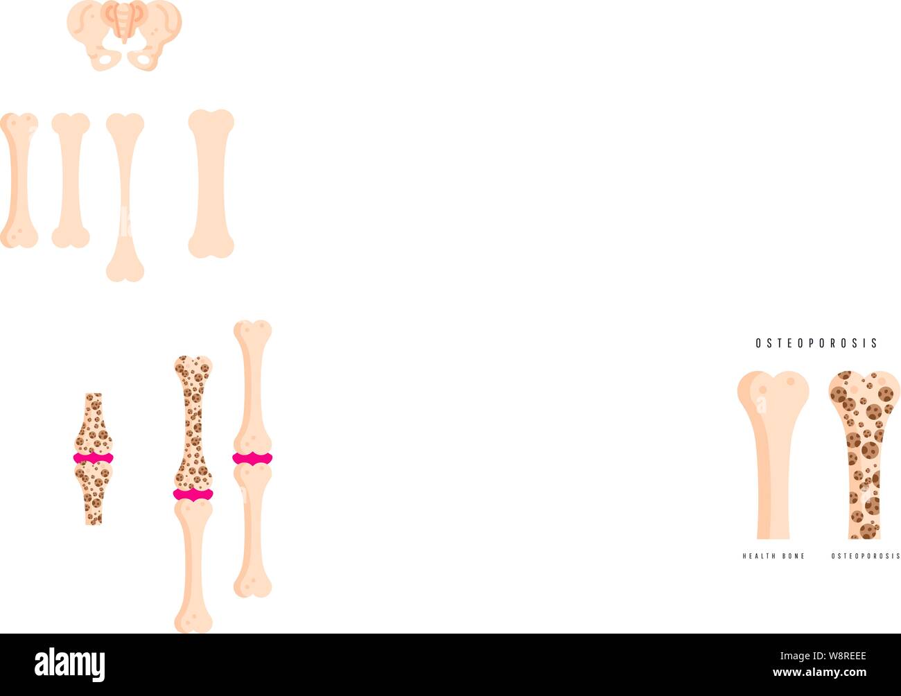 Illustration of osteoporosis bone and healthy bone. Two bones are ...