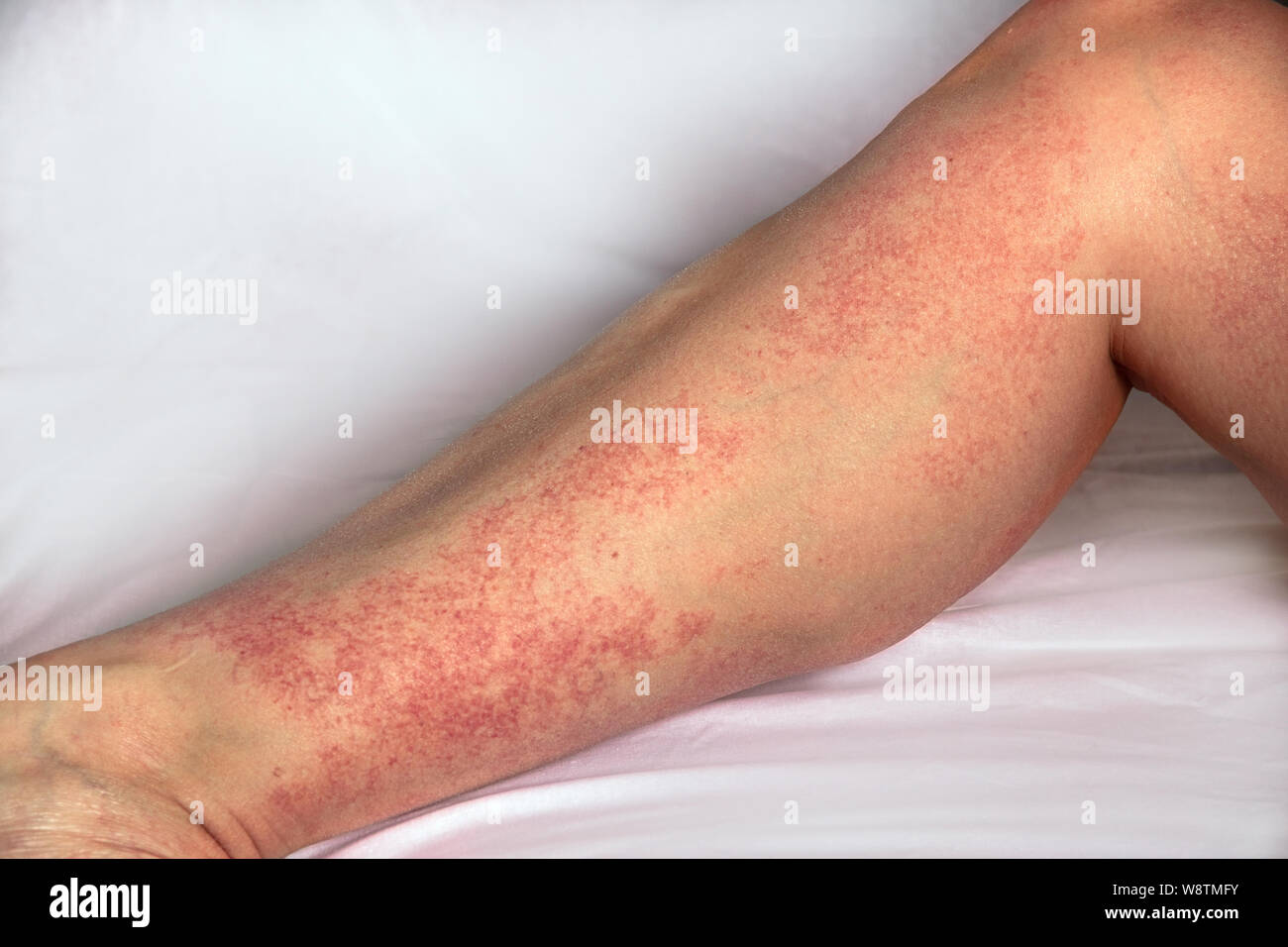Urticaria leg hi-res stock photography and images - Alamy