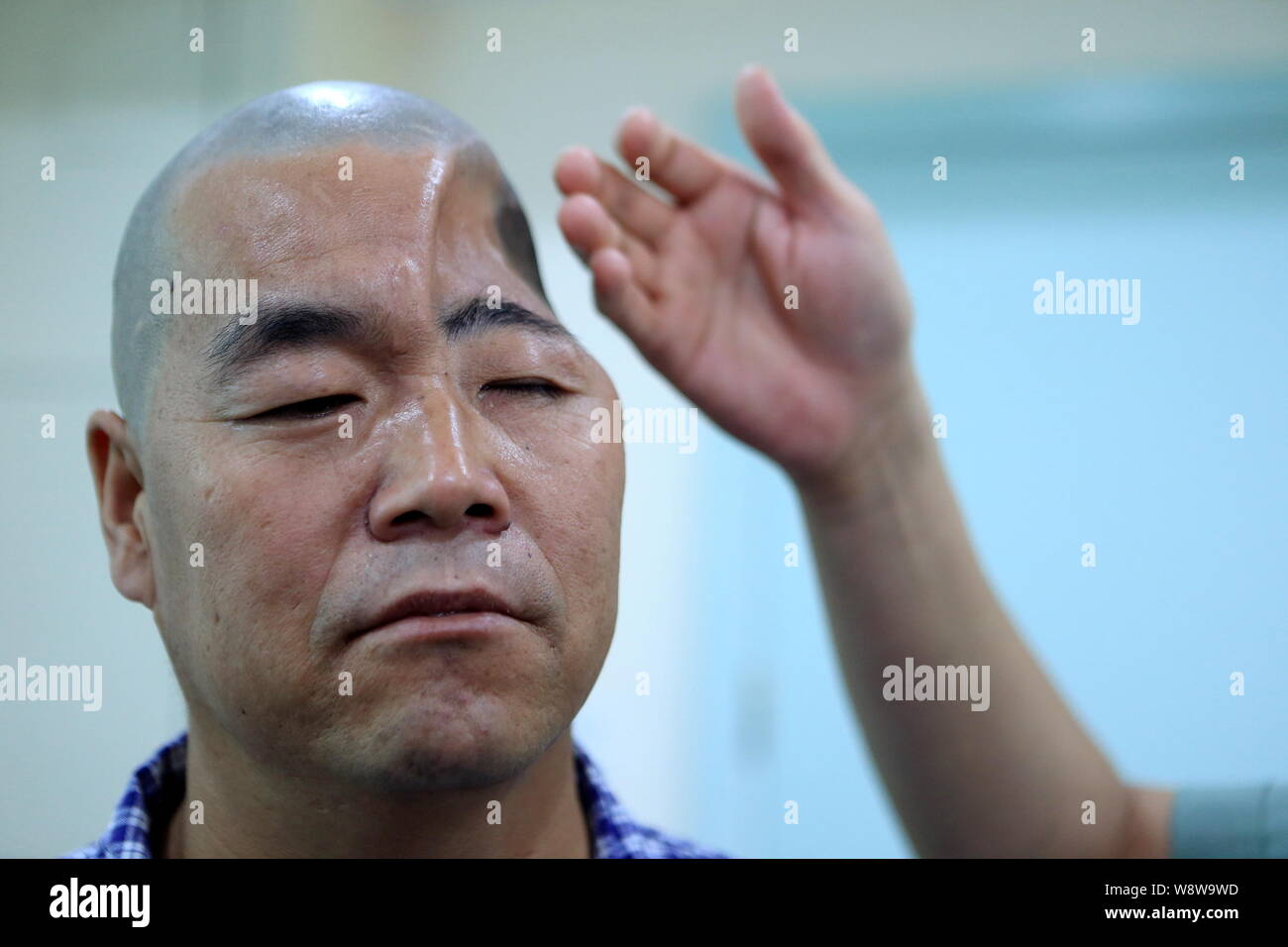 46-year-old Hu, who lost half of his skull in an accident, is pictured ...