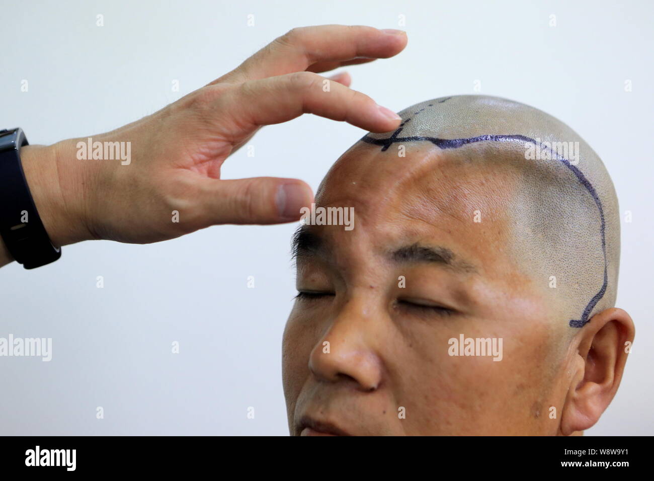 A doctor shows lines he drew on the skull of 46-year-old Hu, who lost ...