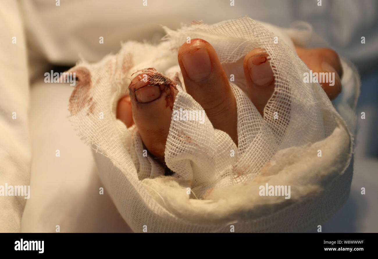 The new ring finger, left, on the left hand of A Yuan is pictured after ...