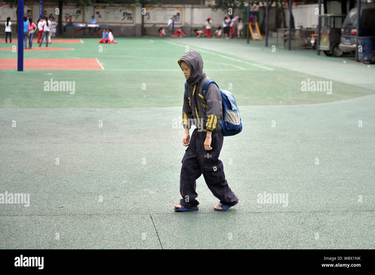 Liu Liangchen, who wraps himself up with preservative film because of a rare skin disease, walks ...