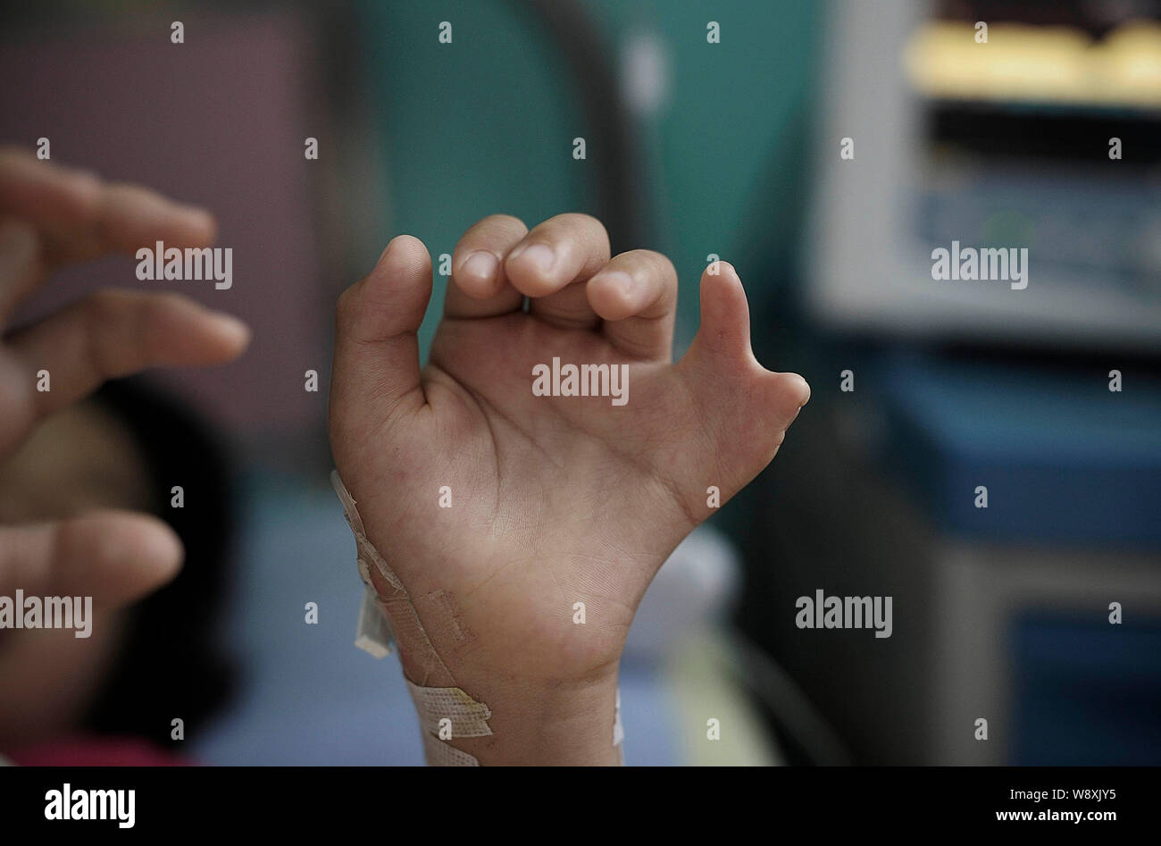 Baby Born With 12 Fingers And 12 Toes