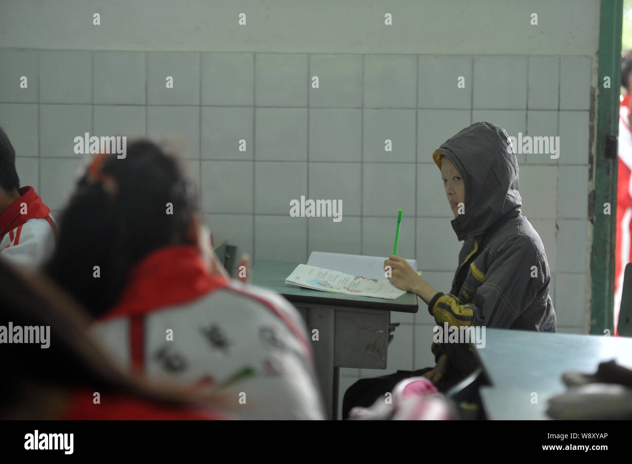 Liu Liangchen, right, who wraps himself up with preservative film because of a rare skin disease ...