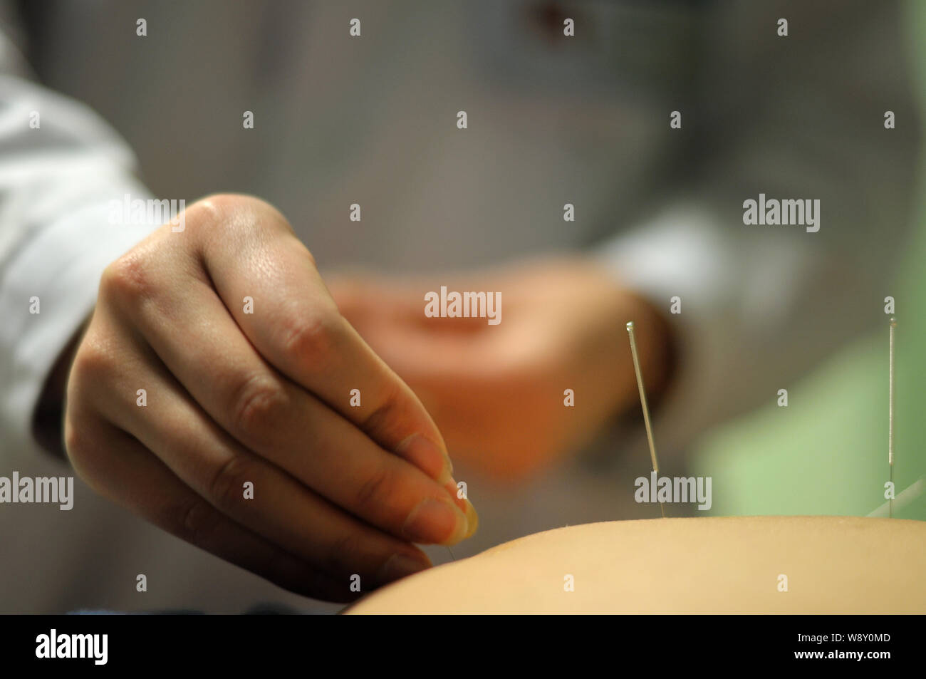 --FILE--A doctor applies acupuncture of traditional Chinese medicine ...