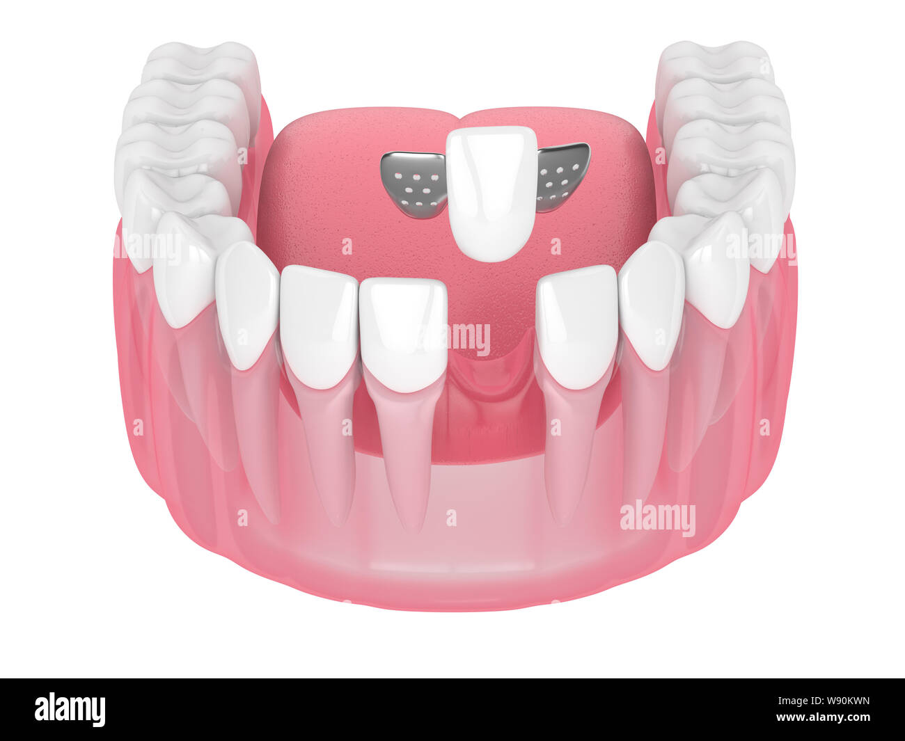 3d render of jaw with teeth and maryland bridge over white background ...
