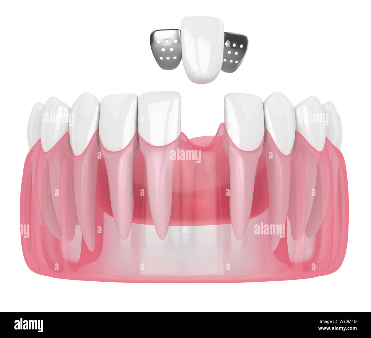 3d render of jaw with teeth and maryland bridge over white background ...