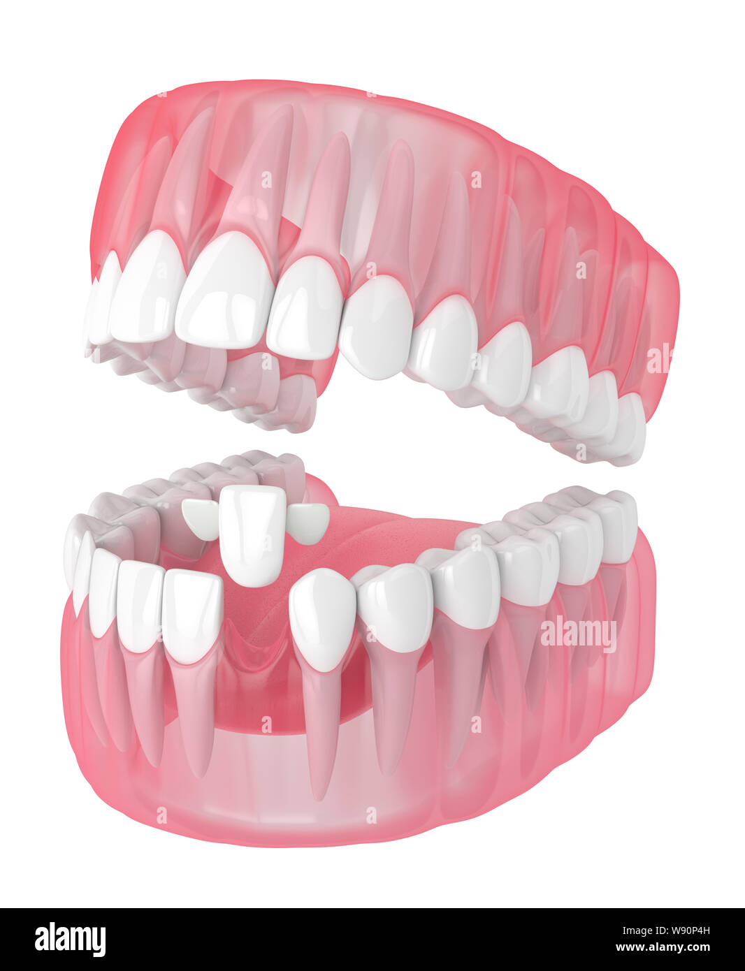 3d render of jaw with teeth and maryland bridge over white background ...