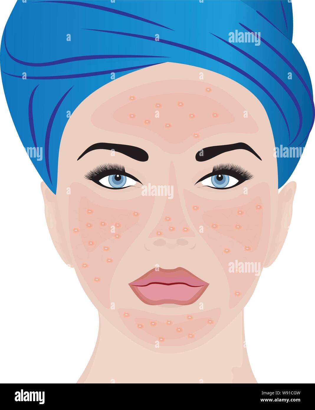 Rosacea Moderate On A Woman Face Vector Illustration Stock Vector Image
