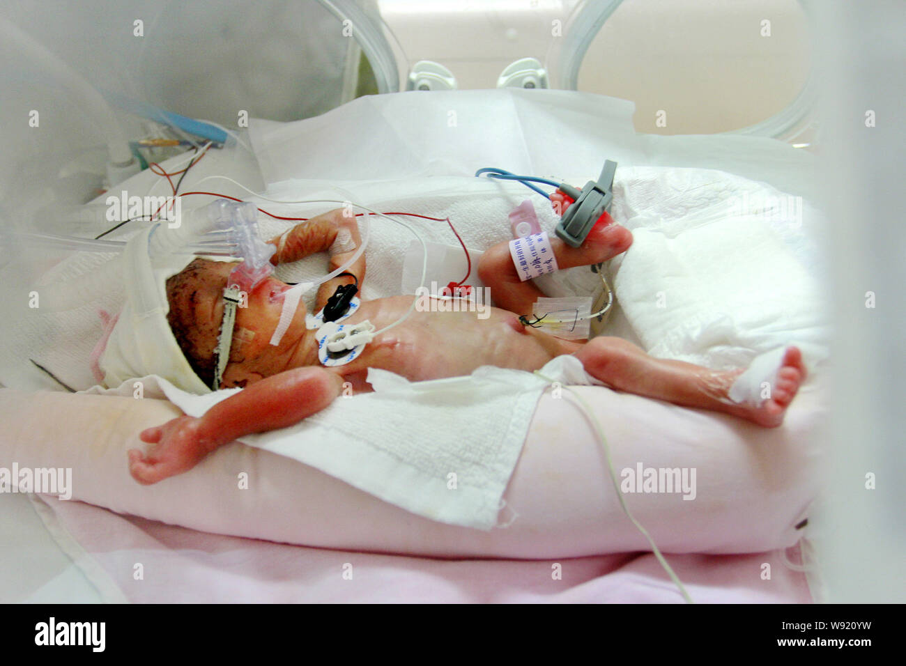 The premature female infant receives medical treatment inside an ...