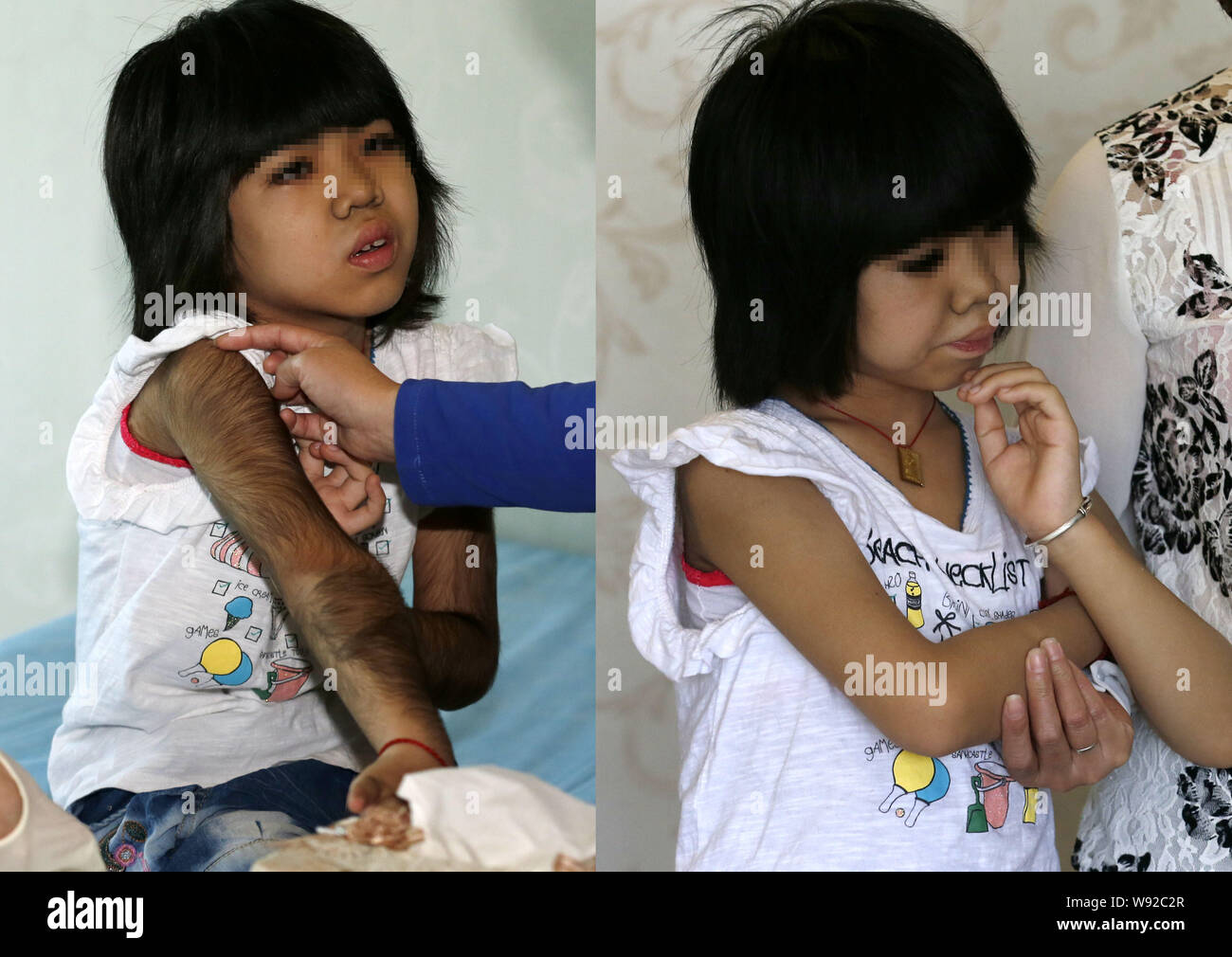 This composite image shows the young Chinese girl Ting Ting who has ...