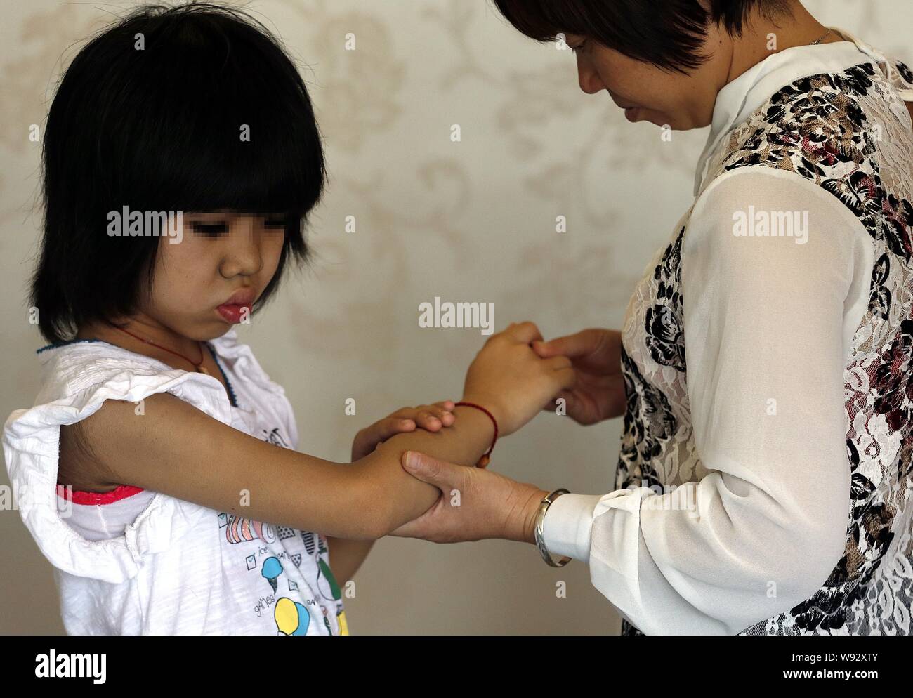 The young Chinese girl Ting Ting (left) who has dense hair on her arms ...