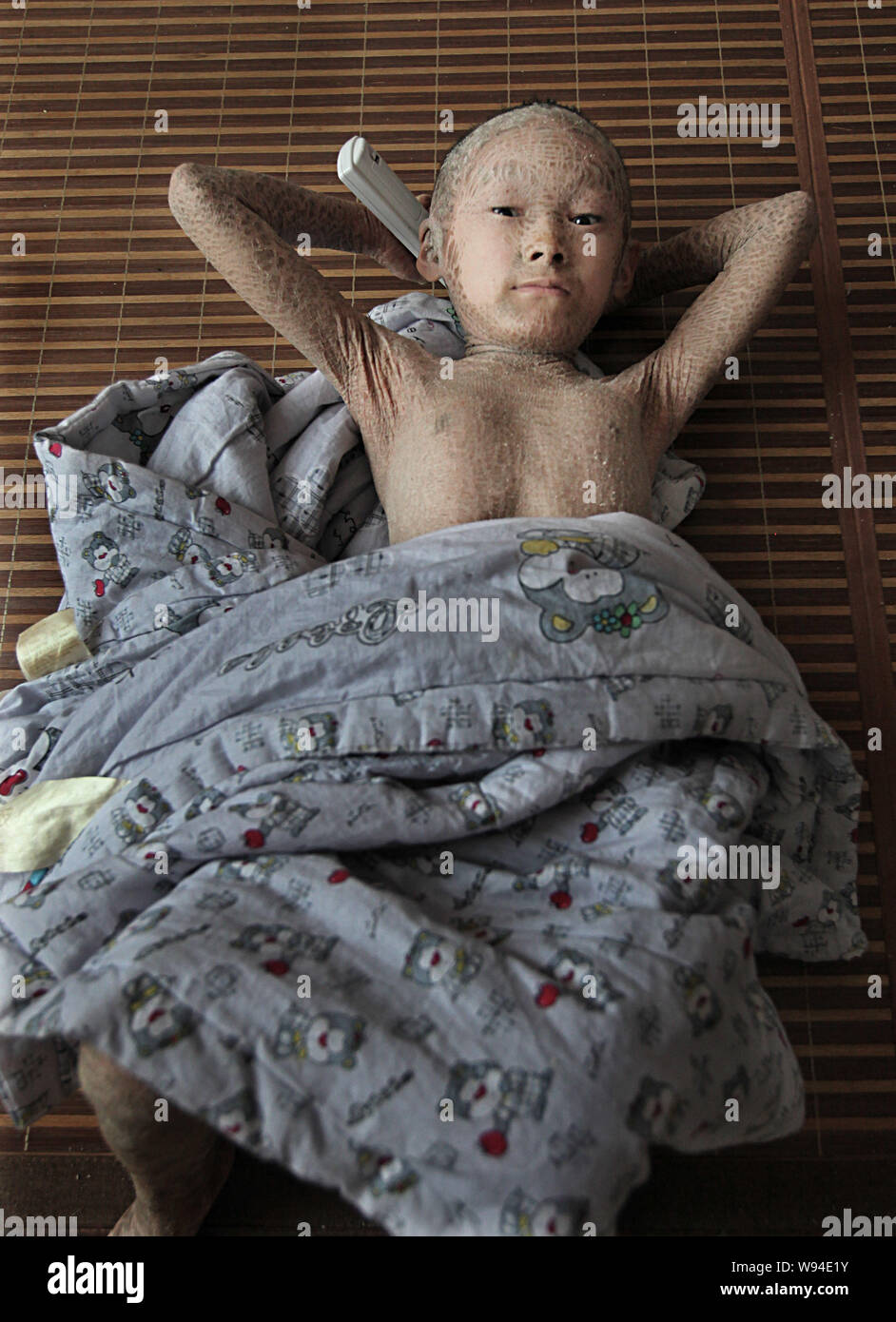 Pan Xianhang, the 8-year-old boy who has fishskin-shaped skin covering ...